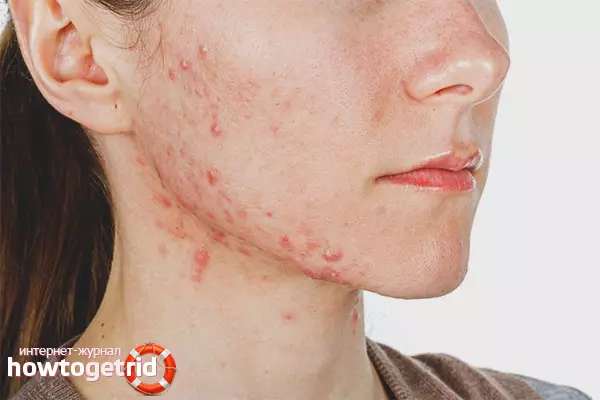 Acne op jukbeensten van vrouwen: oorzaken en behandeling