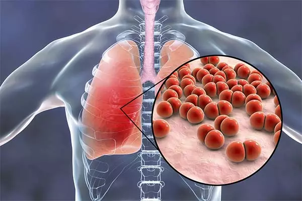 Gejala apa yang menunjukkan bahwa Anda memiliki pneumonia