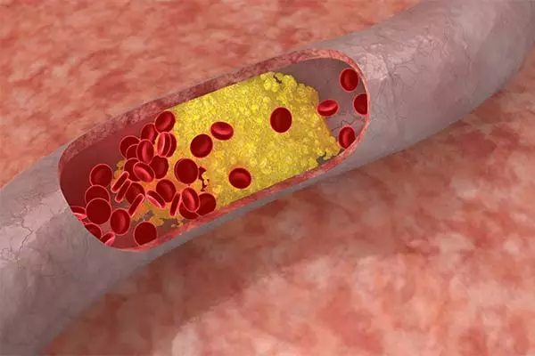 Hoe ontdoen van cholesterol