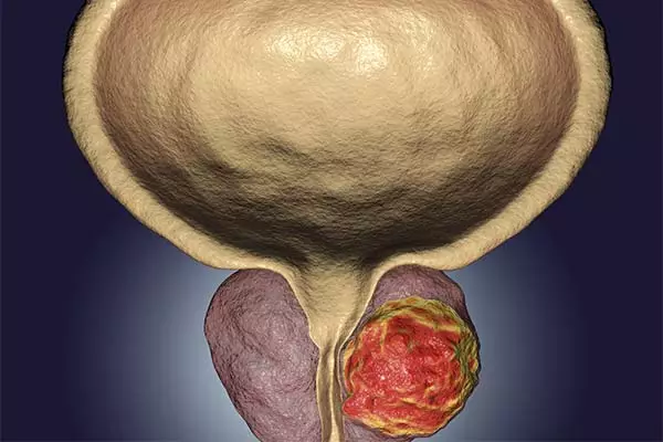 What symptoms indicate that you have prostate adenoma