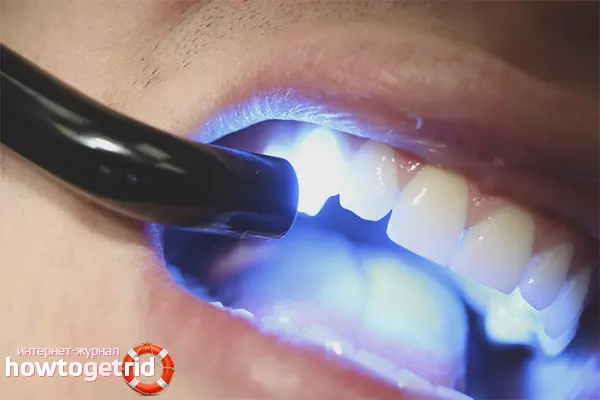 Kostir og gallar af Laser Teeth Whitening