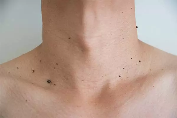 How to get rid of papillom on the neck