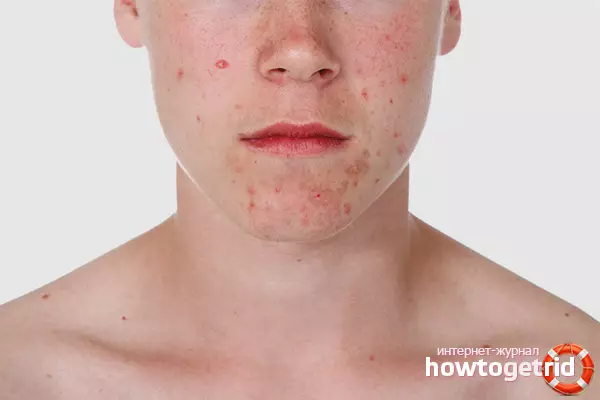 I-acne kwi-chin emadodeni