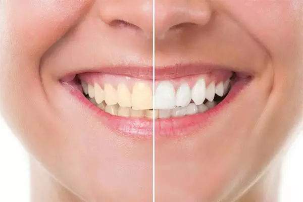 দাঁত whitening.