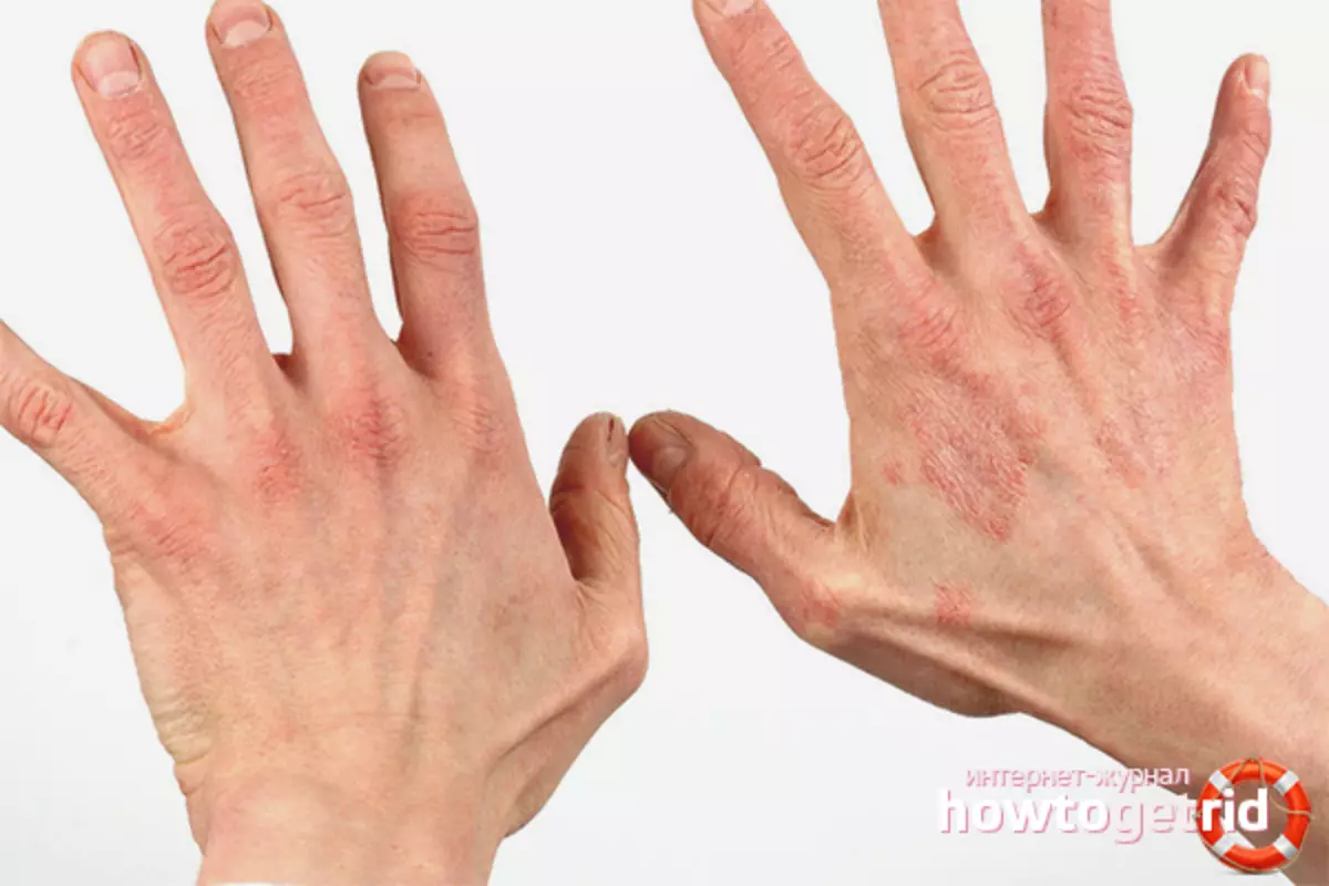 Varieties of eczema