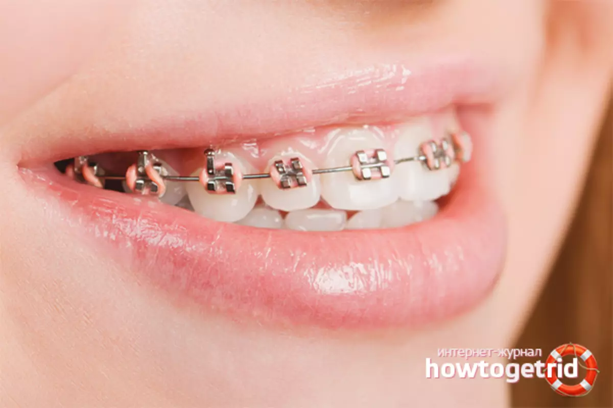 Braces аз ҷойҳои байни дандонҳо