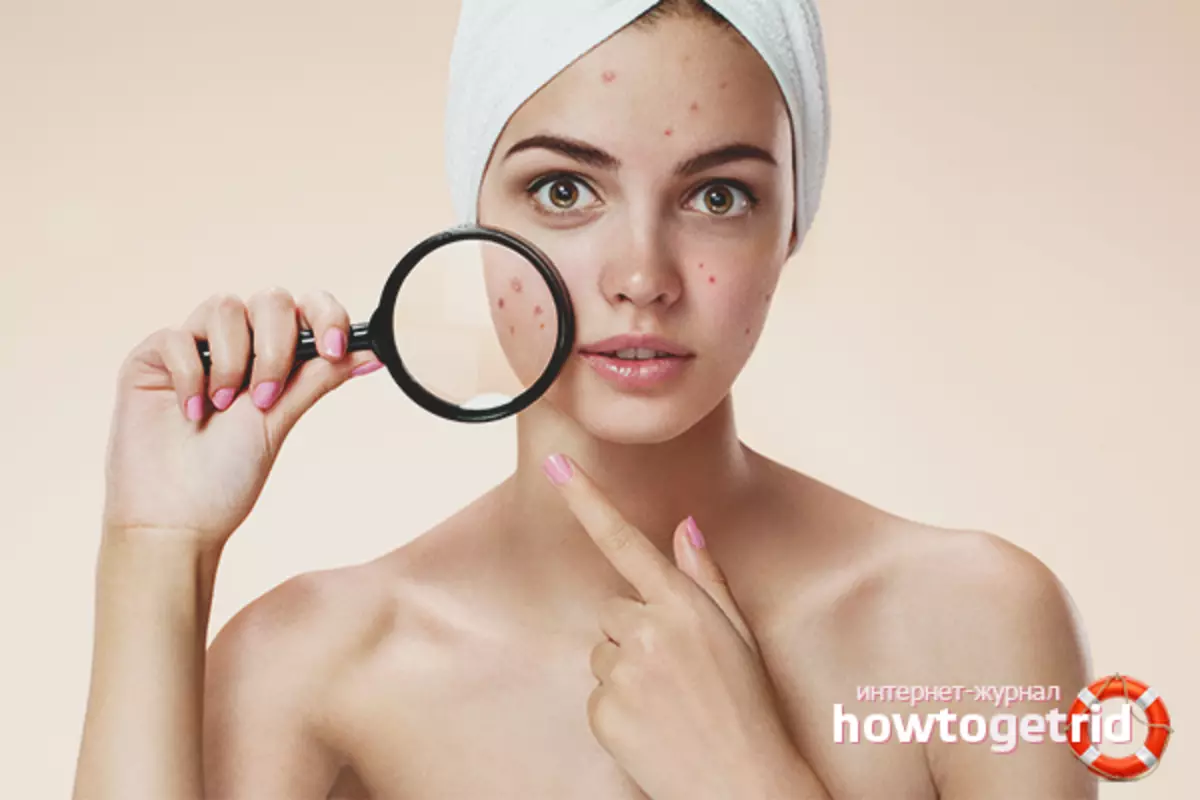 Como remover a acne de vermelhidão