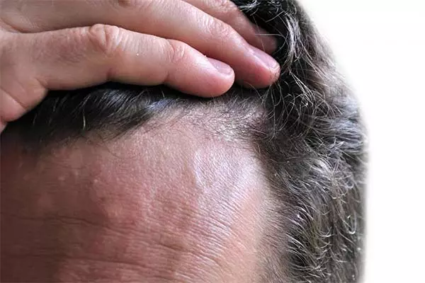 سر پر psoriasis سے چھٹکارا حاصل کرنے کے لئے کس طرح: مناسب غذائیت اور علاج