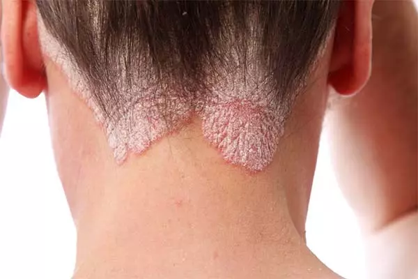 Meriv çawa psoriasis li ser serê xwe derman dike